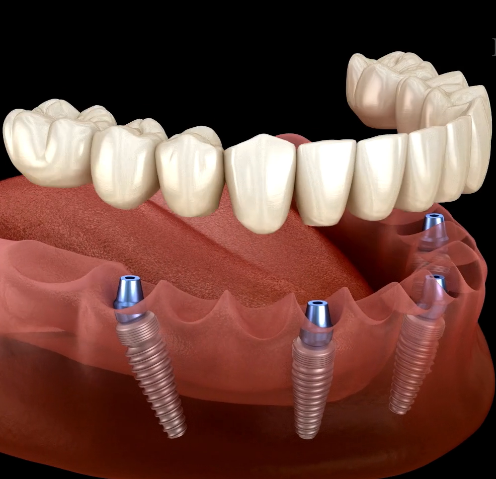 Denvolve Dentist located in Plumstead, Woolwich, London Dental Implants